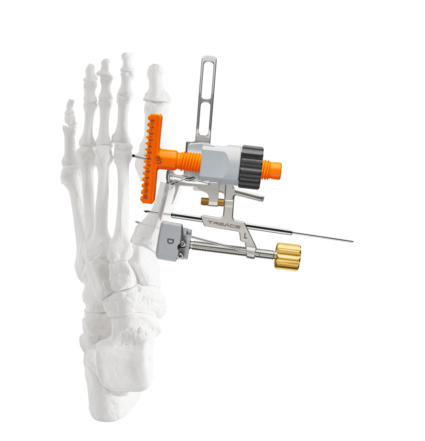 SpeedMTP® | Rapid Compression for First MTP Fusion