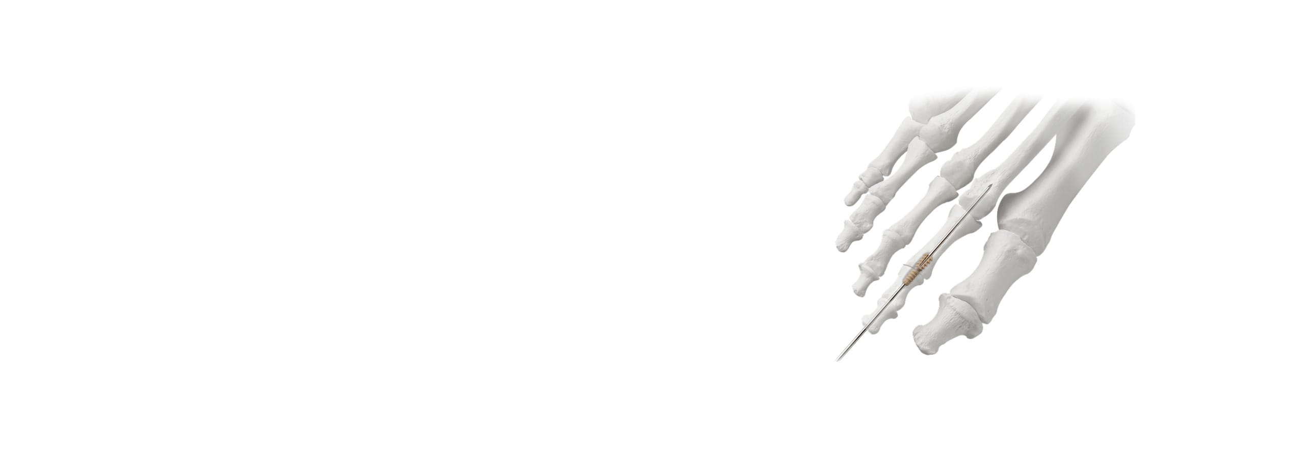 Hammertoe PEEK Fixation System | Treace Surgical Solutions