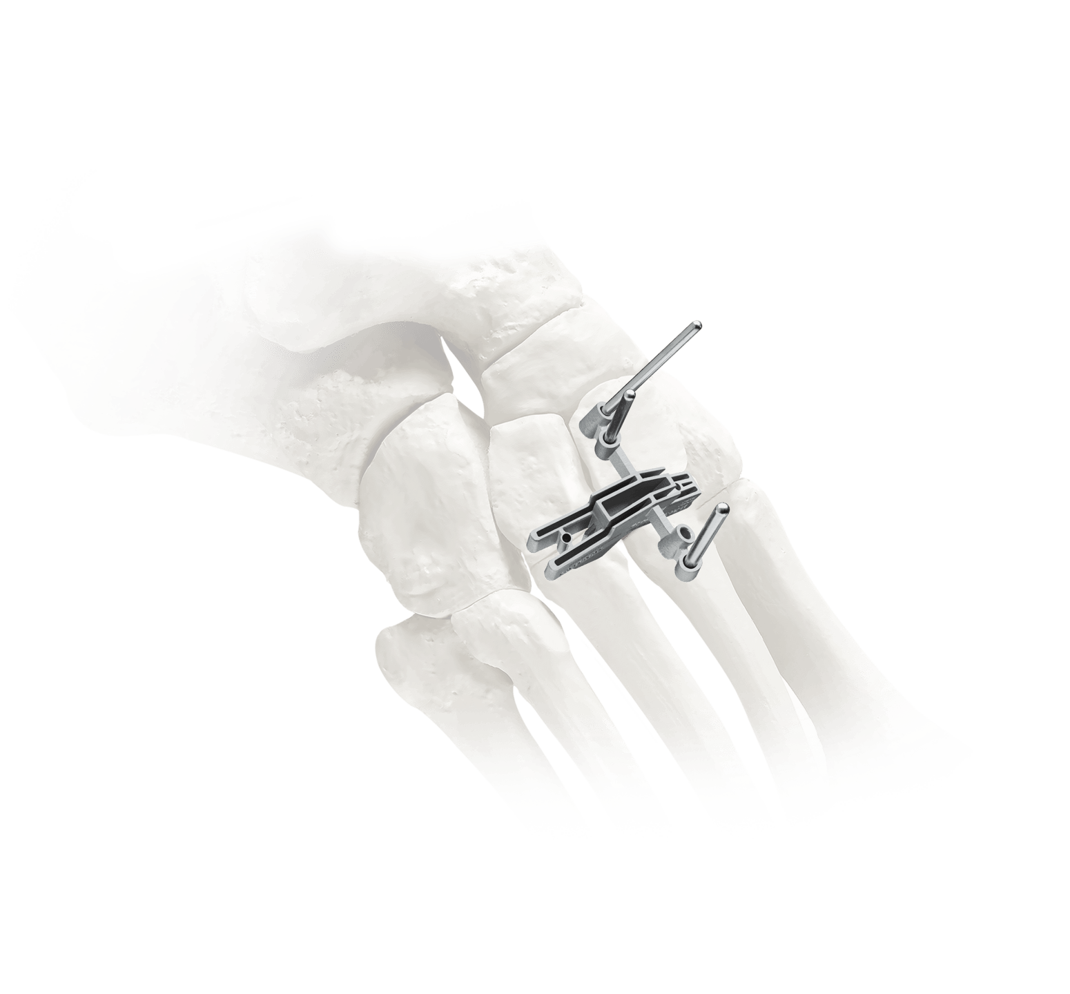 Nanoplasty® System | Minimally Invasive 3D Bunion Correction