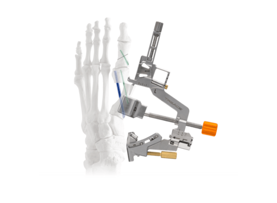 Percuplasty™ and Nanoplasty™ | MIS 3D Bunion Correction