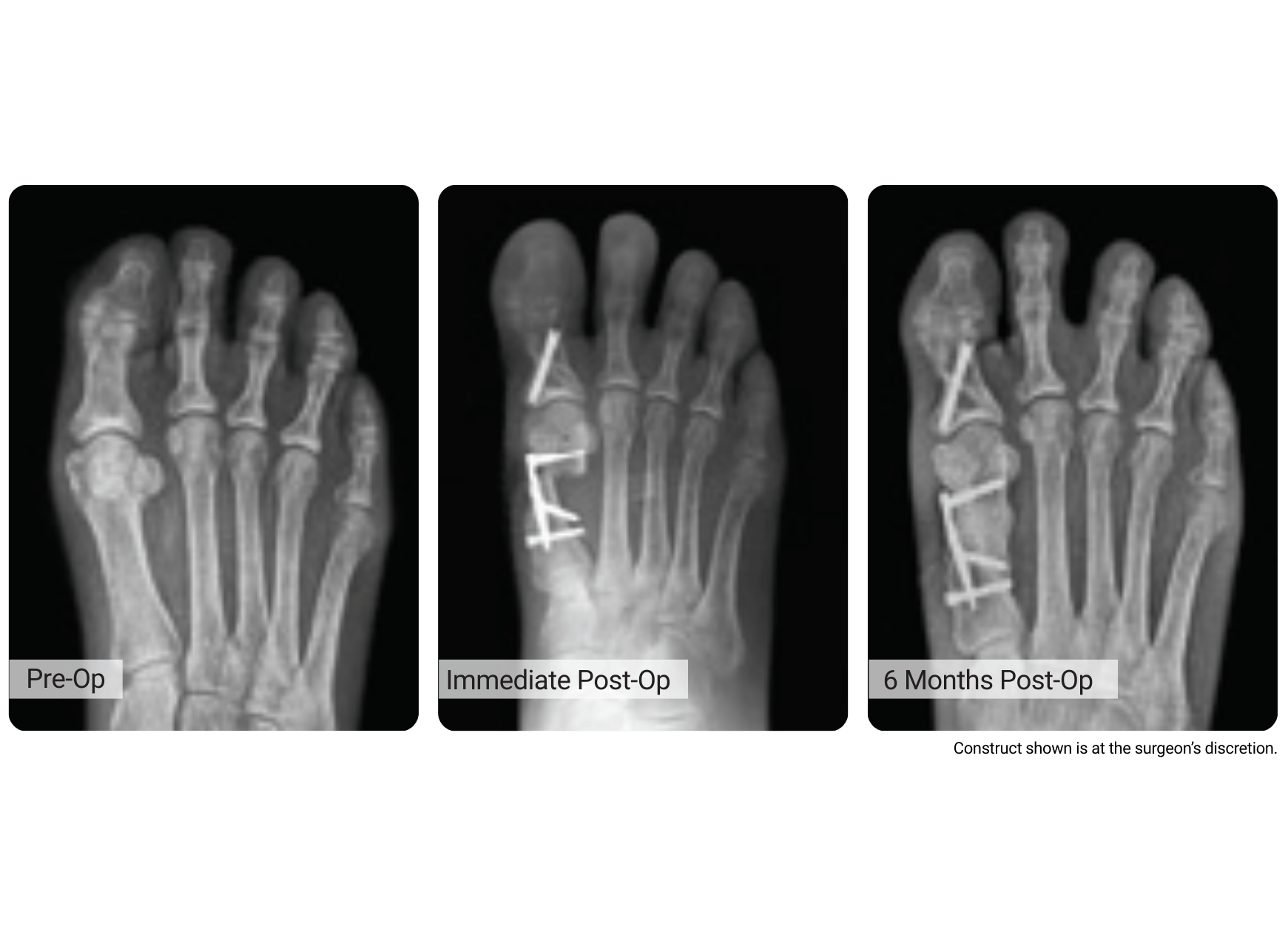 Percuplasty™ and Nanoplasty™ | MIS 3D Bunion Correction